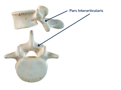 Understanding Spondylolysis: Symptoms, Causes, & Treatment
